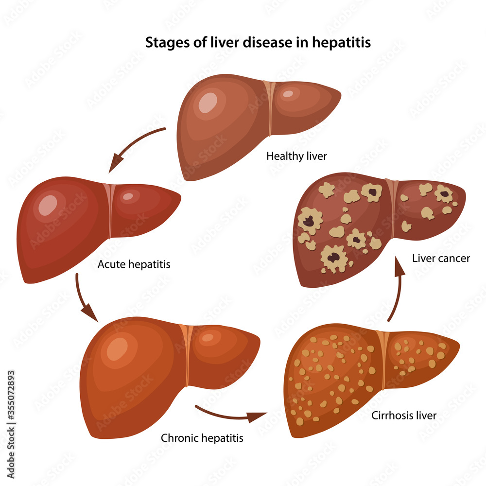 Stages of liver disease in hepatitis with description corresponding steps: healthy, acute ...