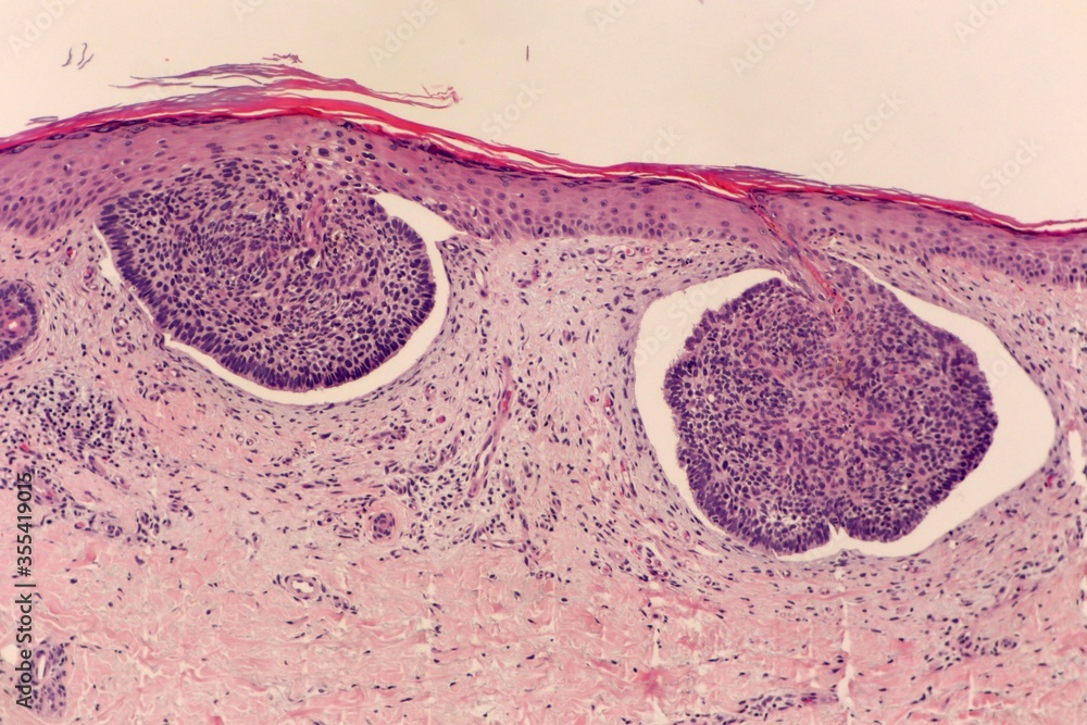 Skin section with a superficial multifocal basal cell carcinoma with ...
