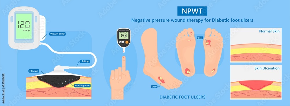 Vacuum assisted closure VAC drain tube treat dead damage pain medicine ...