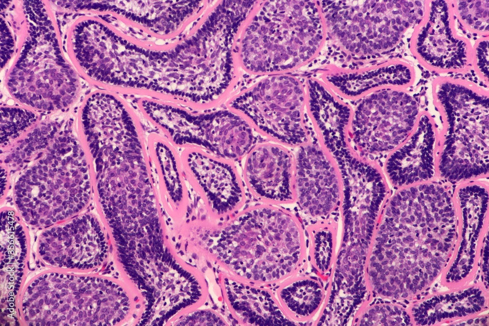 Dermal cylindroma, a benign skin tumor with Nests of two cell ...