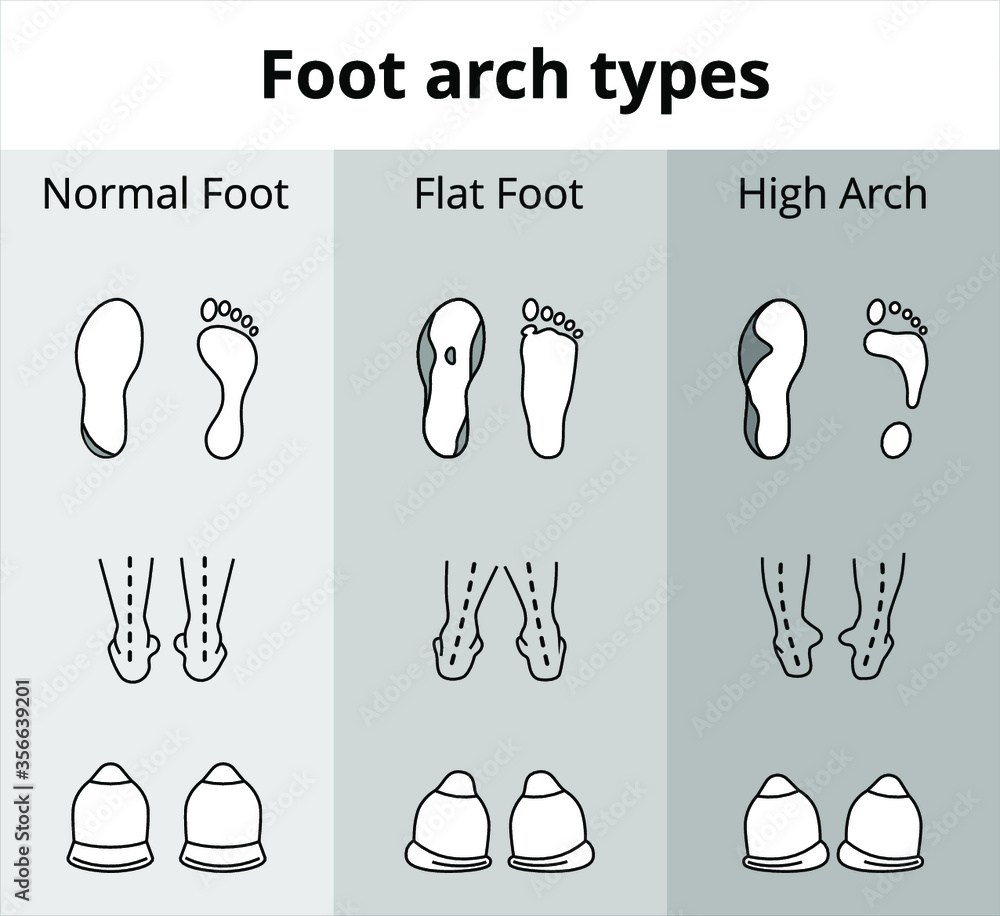 Foot arch types vector infographics. Set of flat foot, high arch Stock ...
