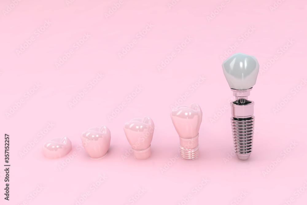 Dental implant close-up pastel pink background with copy space. Dentist ...