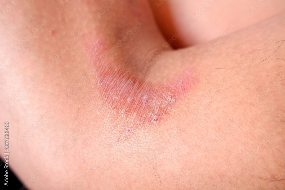 Bad skin condition in knee because of poison liquid of dangerous insect ...