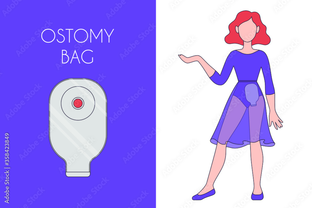cartoon vector illustration of a ostomy bag. A patient with a colostomy ...