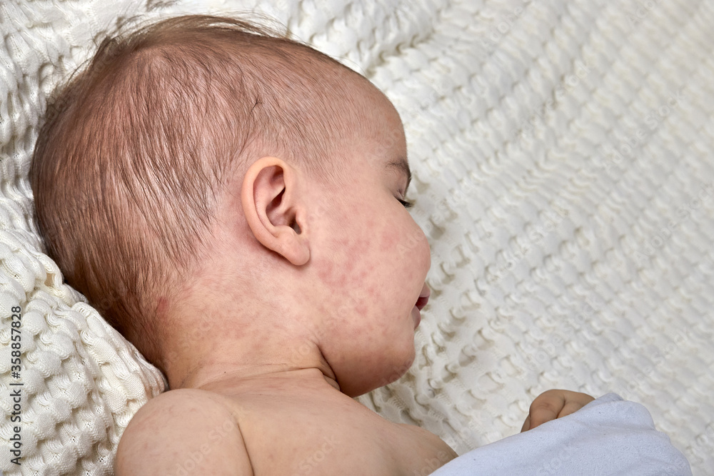 Photo Stock roseola rash a viral rash on the skin of a child | Adobe Stock