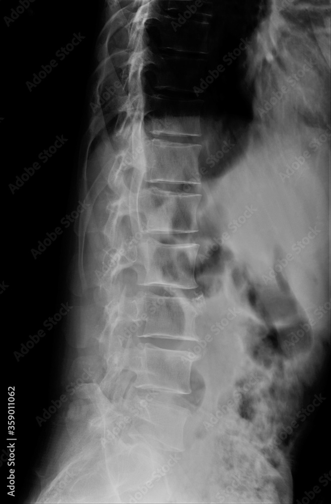 radiography of the lumbar spine in a lateral projection Stock Photo ...