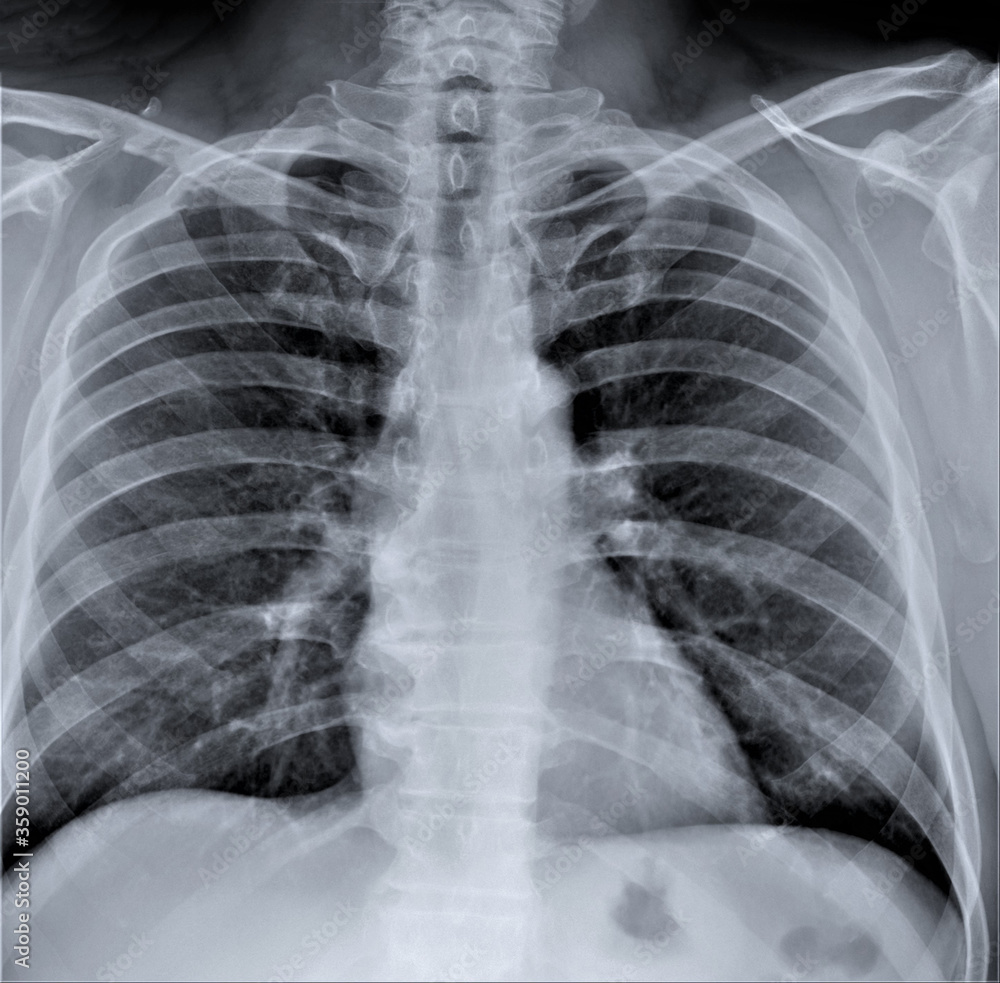 Foto de Stock chest x-ray of an adult .diagnosis of pneumonia | Adobe Stock