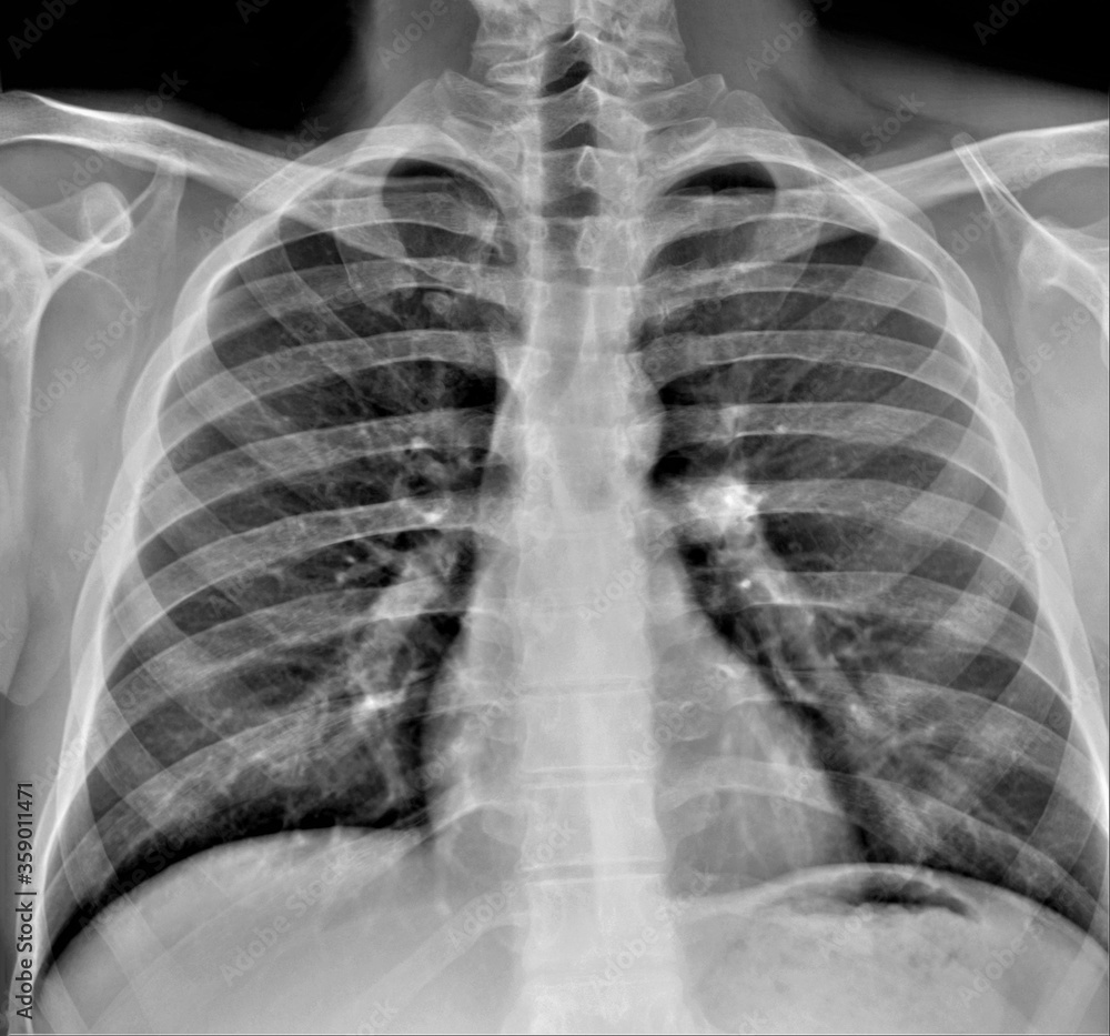 radiography of the chest.diagnosis of lung diseases.pneumonia Stock ...