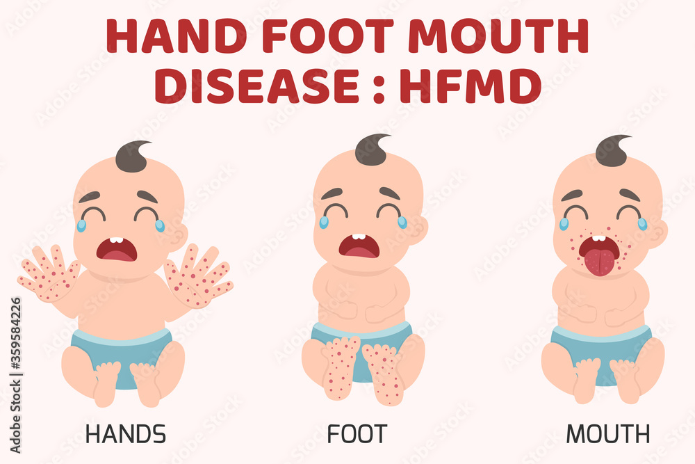เวกเตอร์ Stock HFMD children infected. Hand-foot-mouth disease ...