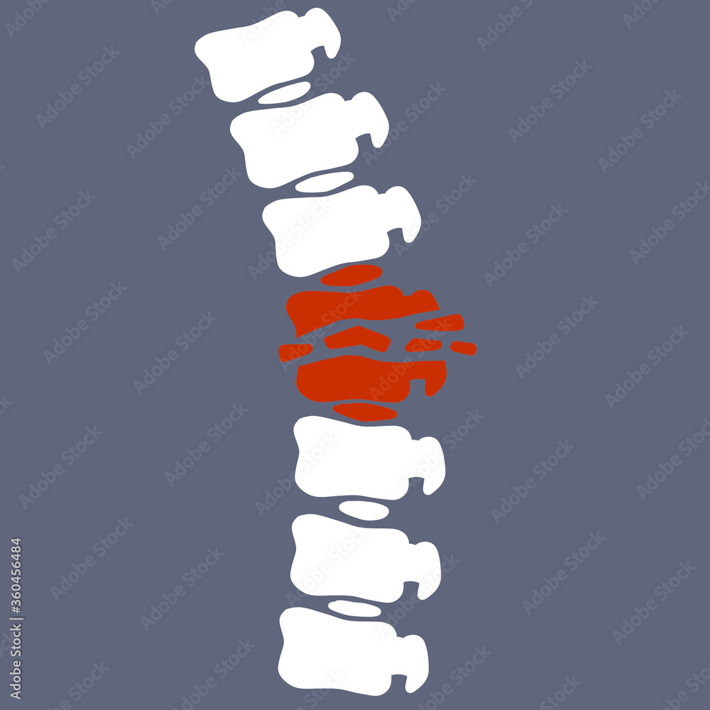 Problems with spine. Posture issues. vertebral column. Crack in the ...