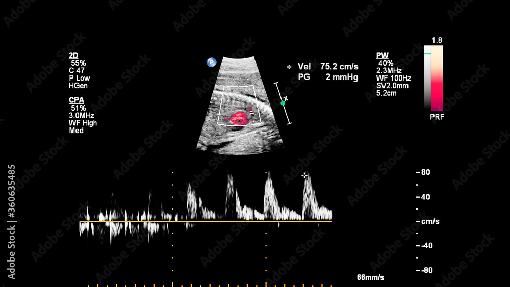 Ultrasound screen with fetal echocardiography Stock Photo | Adobe Stock