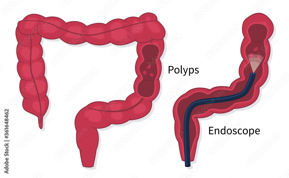 Flat vector illustration of colorectal cancer screening. Colonoscopy ...