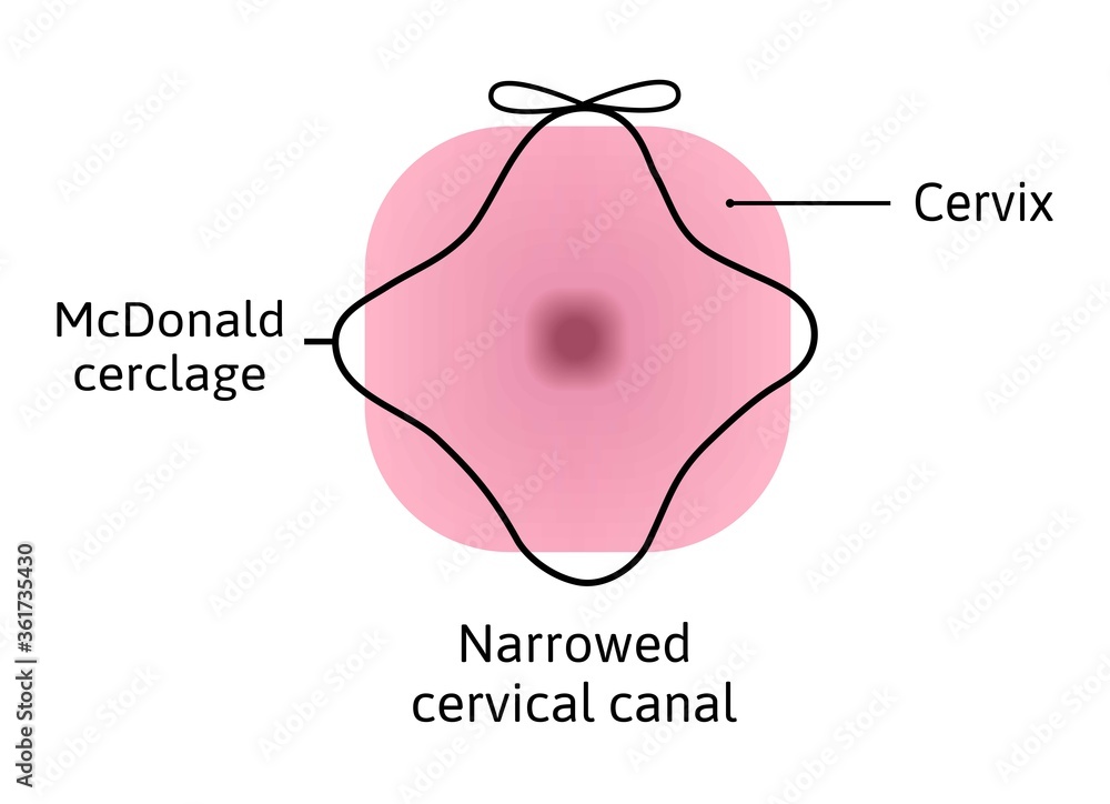 McDonald cerclage tightening of cervix opening during pregnancy ...