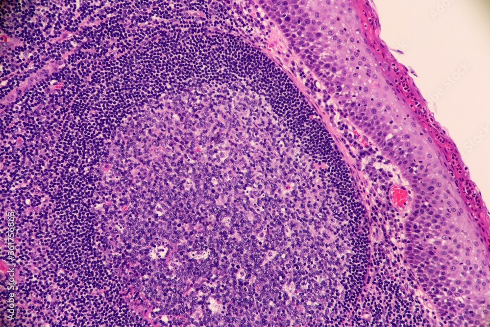 Chronic Tonsillitis with a reactive germinal Center and inflamed ...