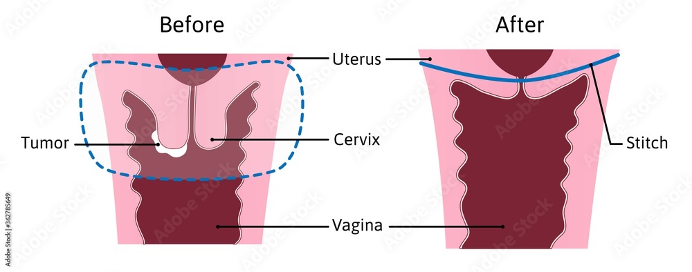 Trachelectomy Surgery Removal Of The Cervix Medical Vector