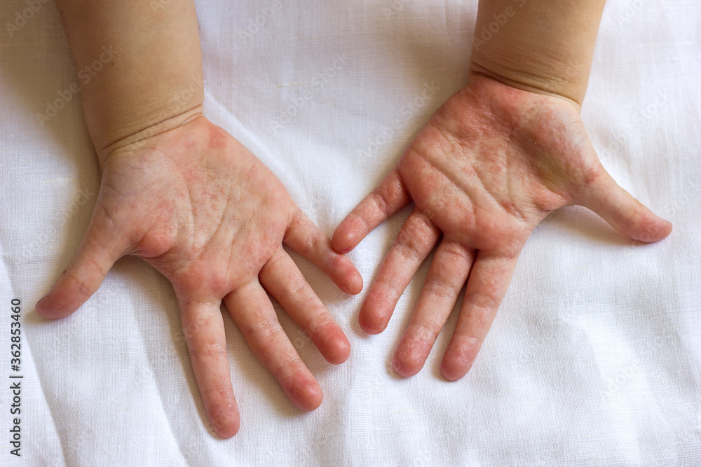 Red rash on the hands of the palms of the child, rubella scarlet fever ...