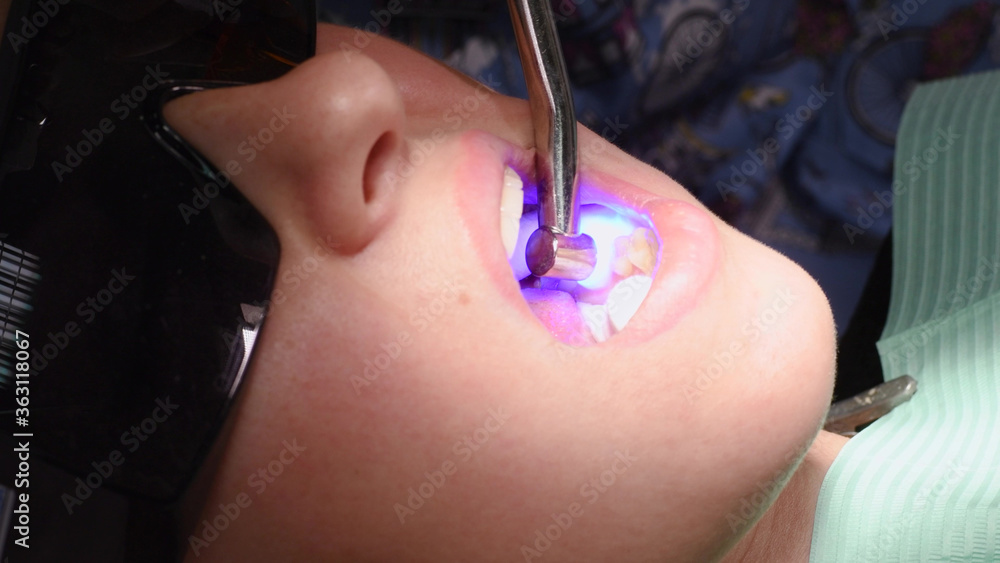 Applying resin based composite filling on tooth and curing it with LED ...