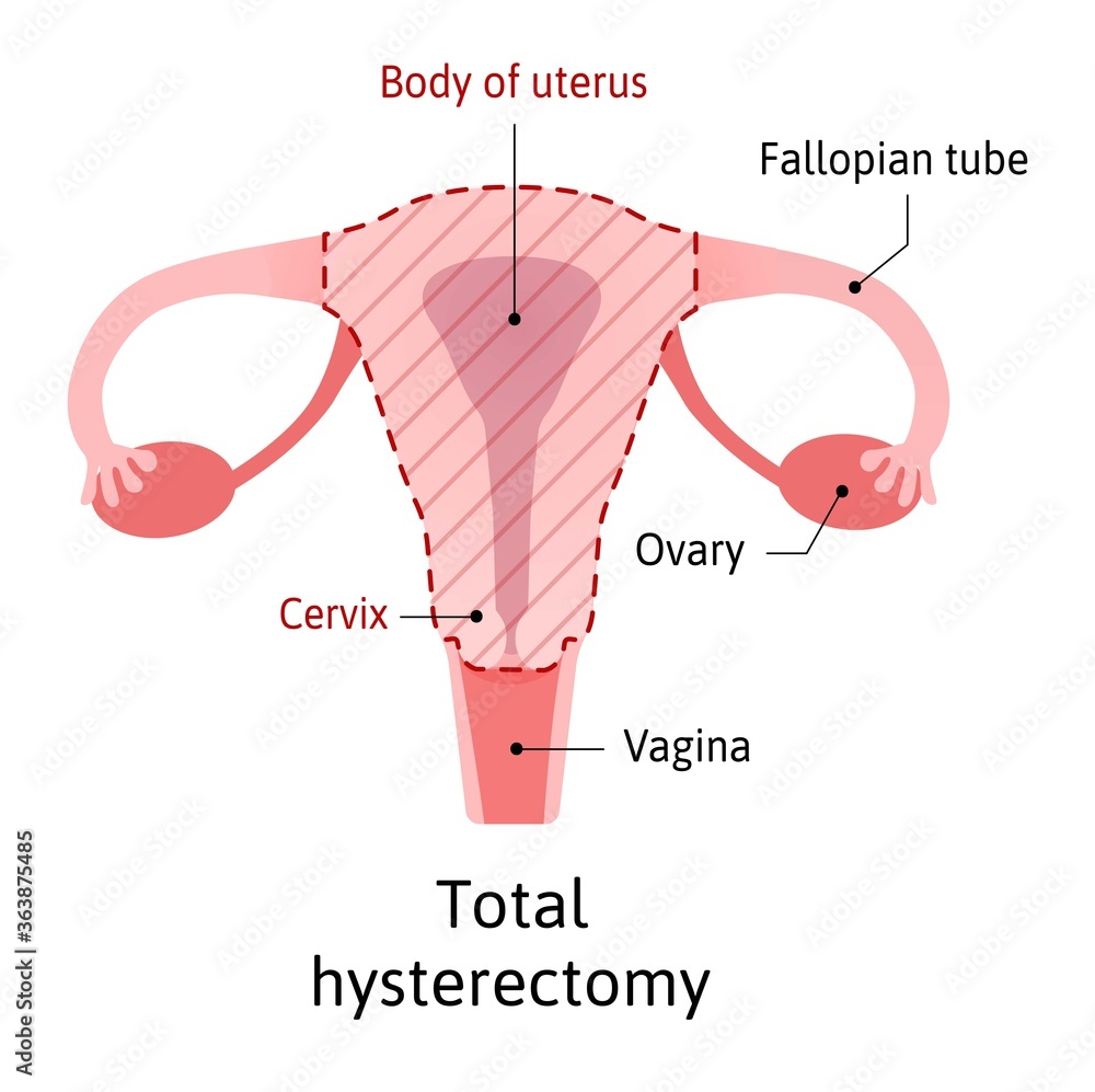 Hysterectomy Surgical Removal Of The Uterus Medical Vector