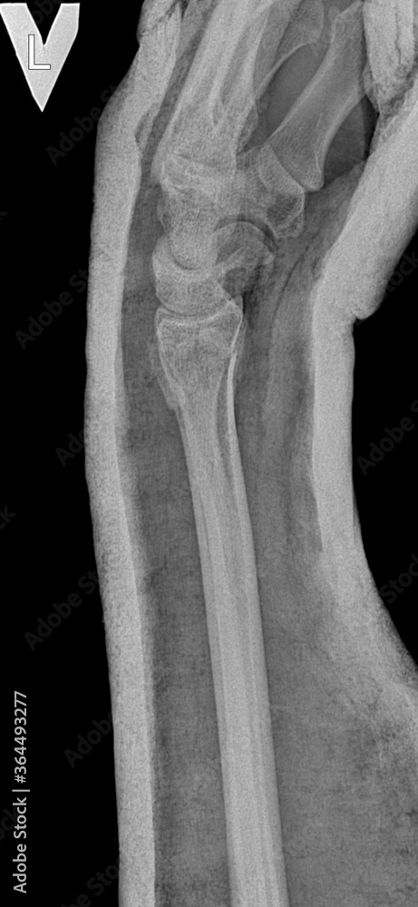 Hand X-ray after bone repositioning. Picture of a broken arm in plaster ...