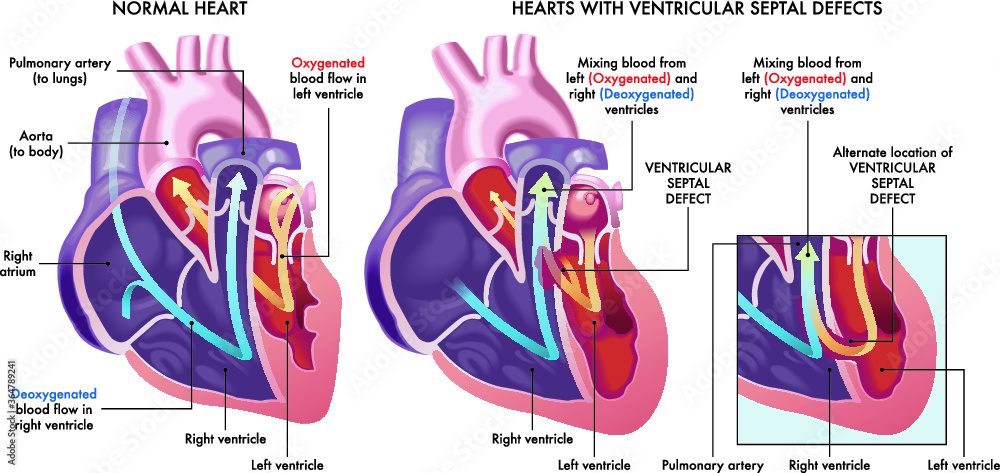 Medical illustration that compares a normal heart with hearts afflicted ...