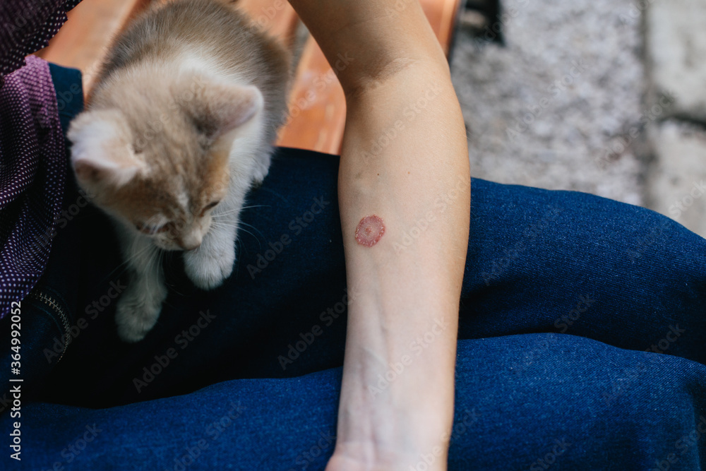 Ringworm on Arm with Hand. Cat disease. Skin problem の Stock フォト ...