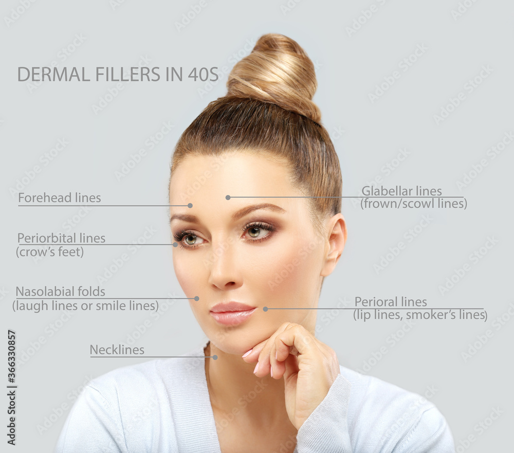 dermal filler treatments in your 40s .Hyaluronic acid injections for ...
