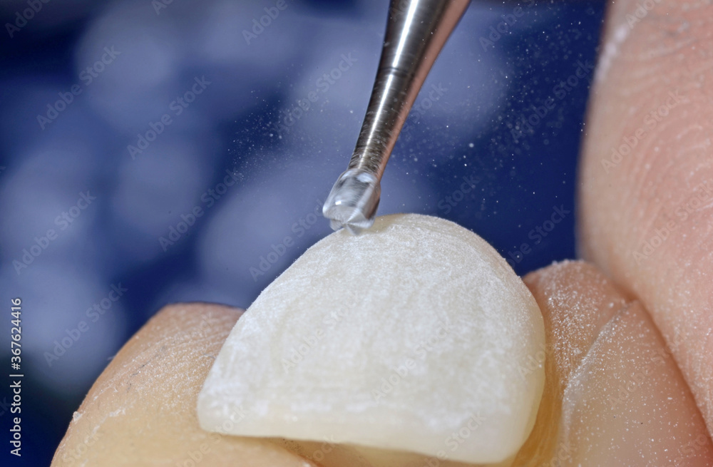 Prosthetics, grinding of artificial teeth in the dental laboratory ...