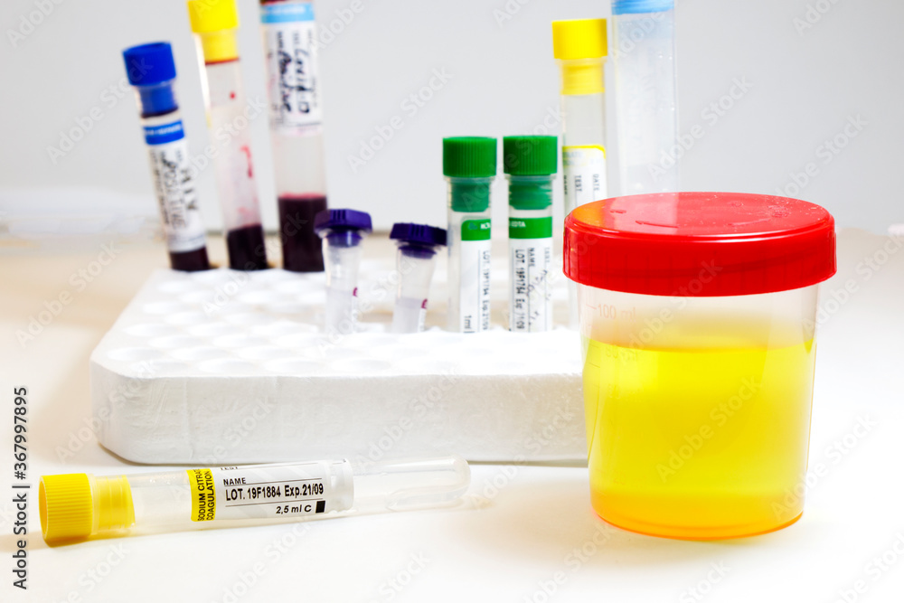 Drug test, medical urine and pee test with blood and other tubes on the ...