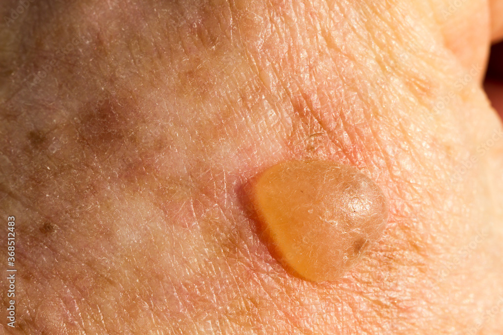 Raised blister caused by cryotherapy to remove solar keratosis lesion ...