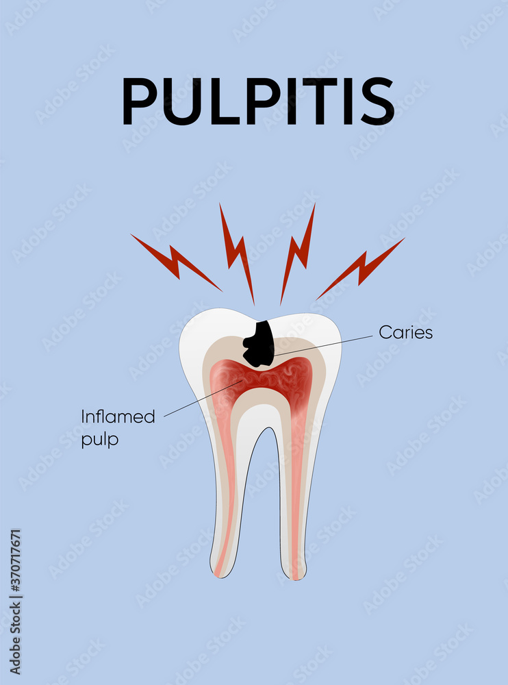 Patient education poster showing the process of caries and pulpitis ...