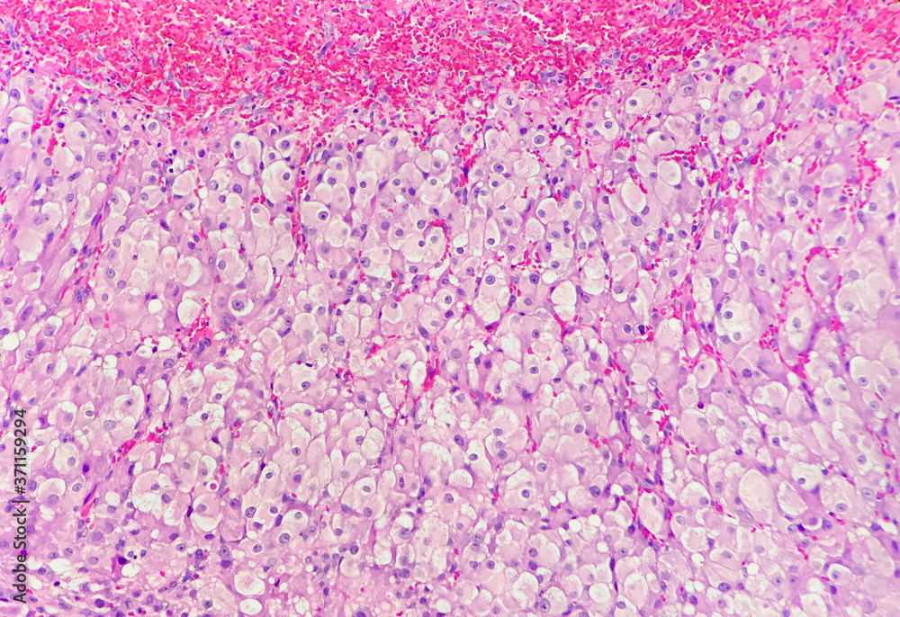 Ilustración de Stock Photo of hemorrhagic corpus luteum in the ovary ...