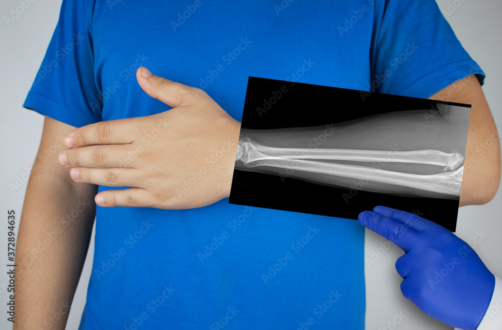 X-ray of a man's forearm. A photograph of the spoke-bone and ulna bones ...