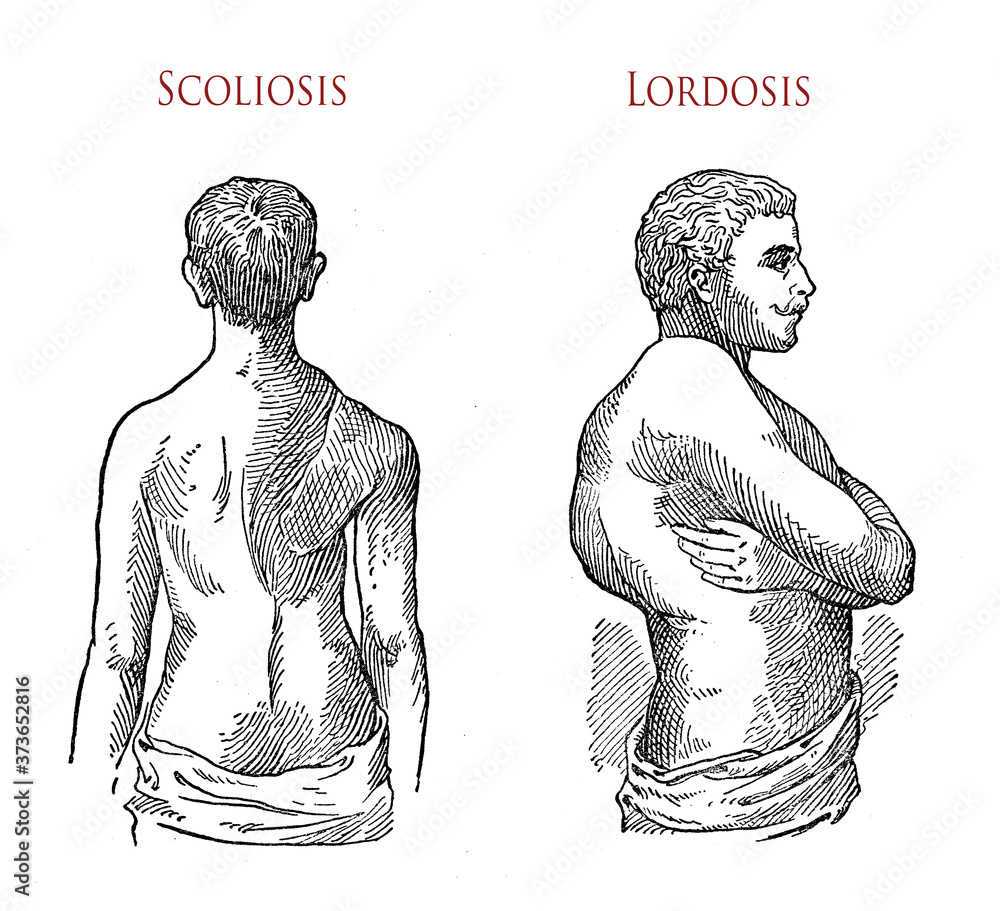 Healthcare and orthopedics: male patients affected by scoliosis (person ...