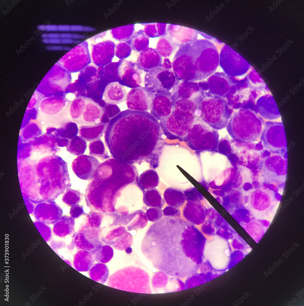 Abnormal cell blood smear science concept. Stock Photo | Adobe Stock