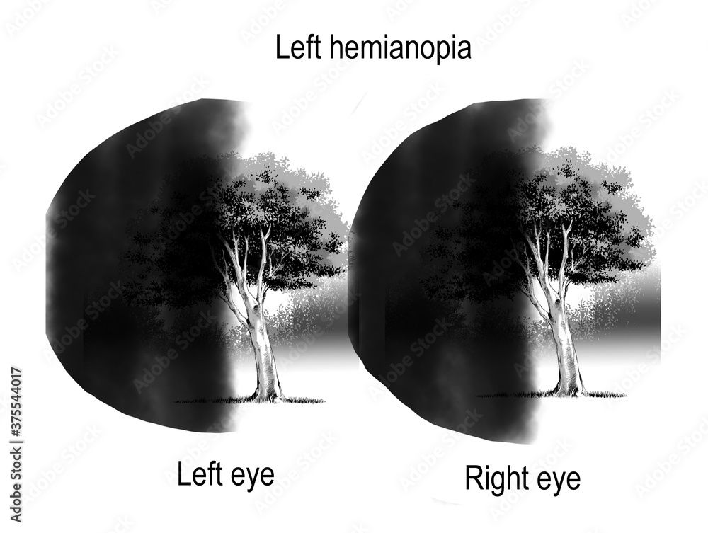 patterns of visual field defects are sign and symtomp of loss of vision ...