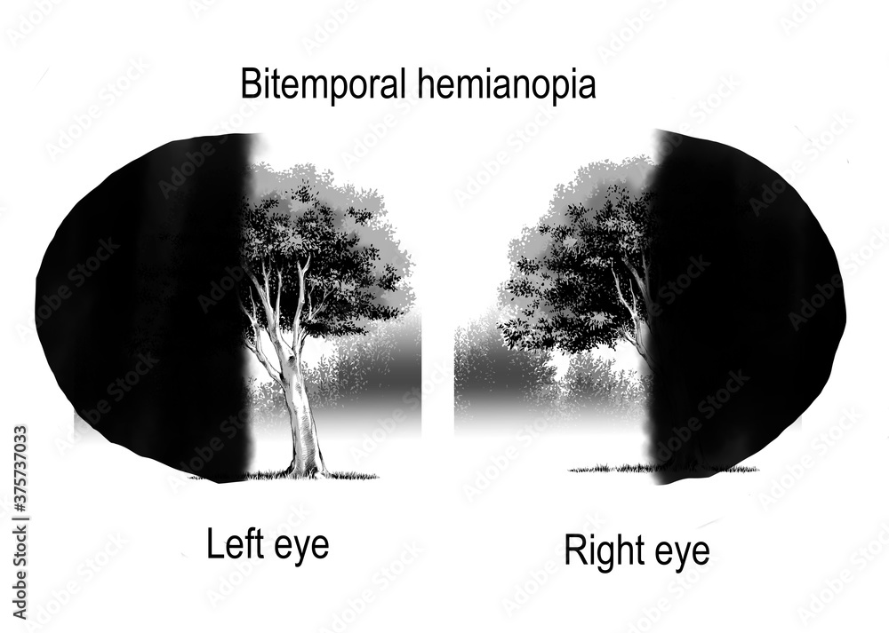 patterns of visual field defects are sign and symtomp of loss of vision ...