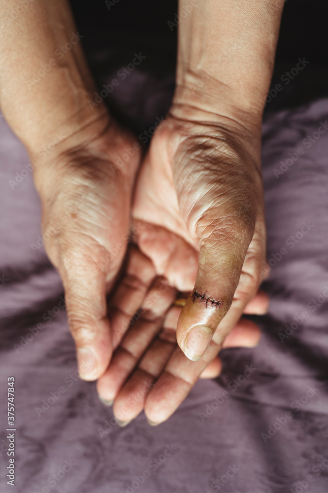 Hand injury Stock Photo | Adobe Stock