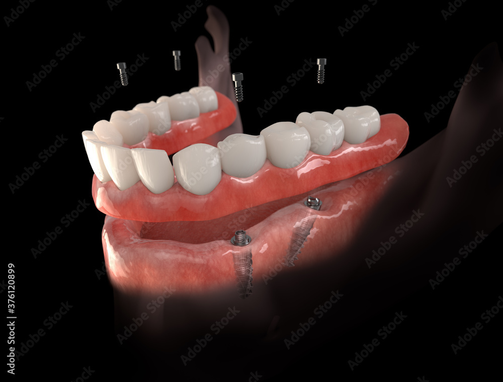Mandibular fixed restoration with 4 implants, posterior are tilted. 3D ...