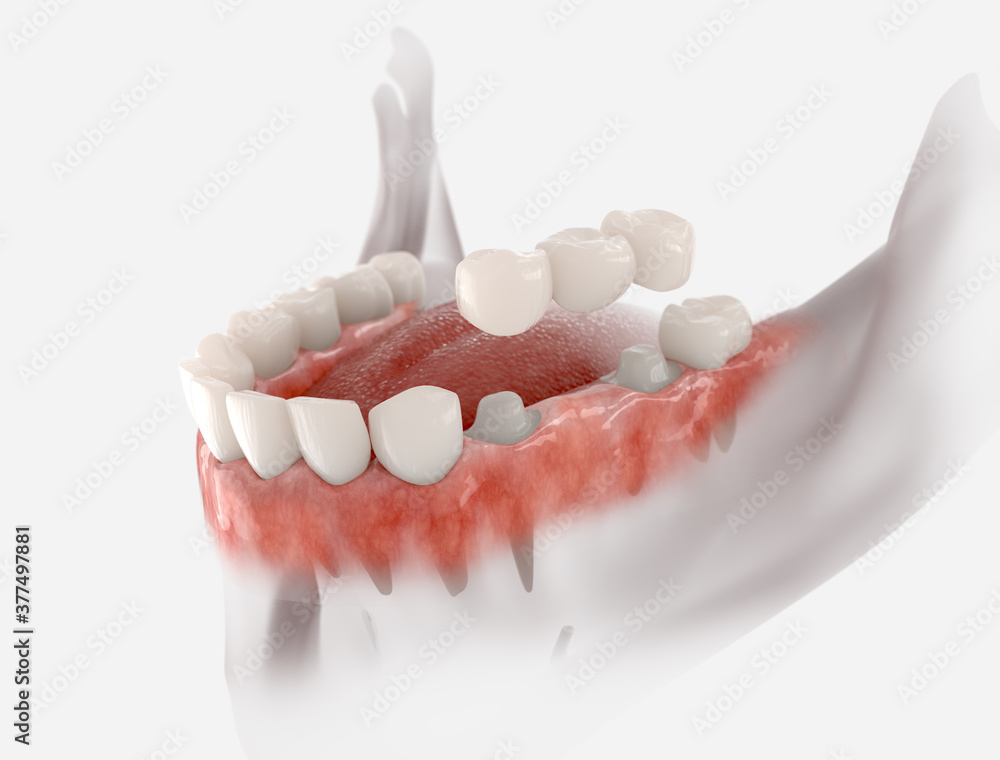 Bridge dental with 3 teeth fixed on molar and premolar. Stock Photo ...