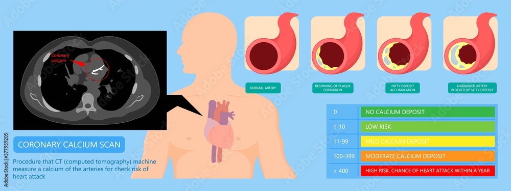 Cardiac Calcium Scoring chest health signs X-ray block treat blood ...