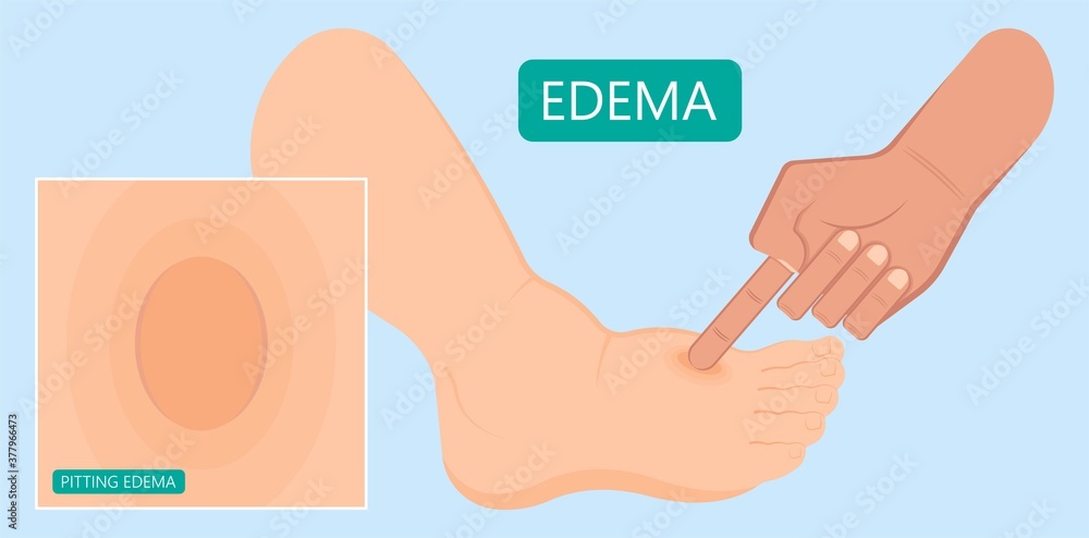 Edema swelling under the skin that affect with ankles and legs ...
