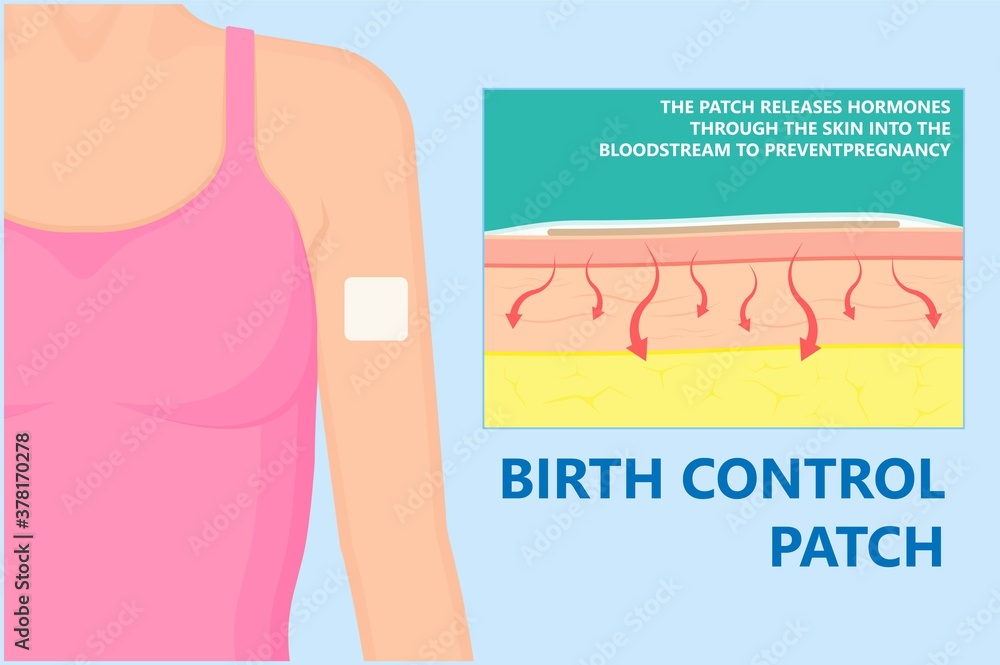 Birth Control Patch to prevent pregnancy Stock Vector | Adobe Stock