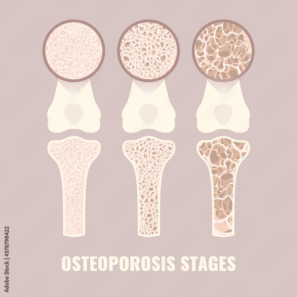 Osteoporosis disease stages from healthy to severe. Bone density loss ...