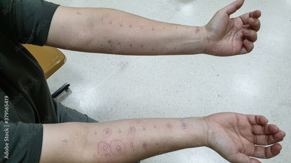 Arm test of allergy droplet examination sensitive symptom red rash all ...