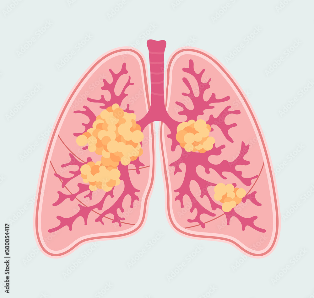 Lung cancer - vector patient-friendly scheme. Anatomical diagram in ...