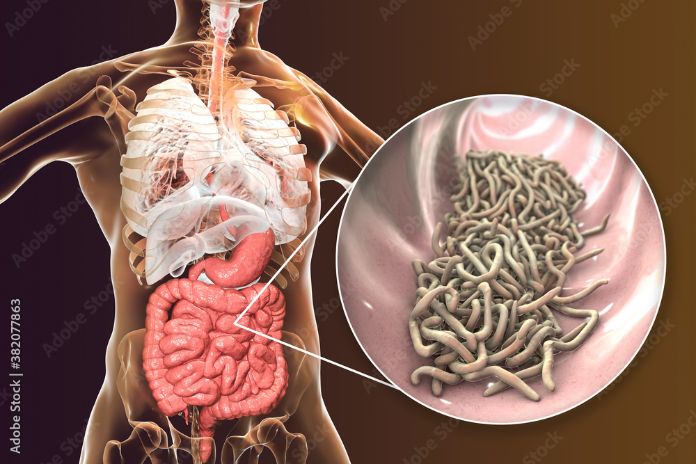Parasitic worms in human intestine Stock Illustration | Adobe Stock