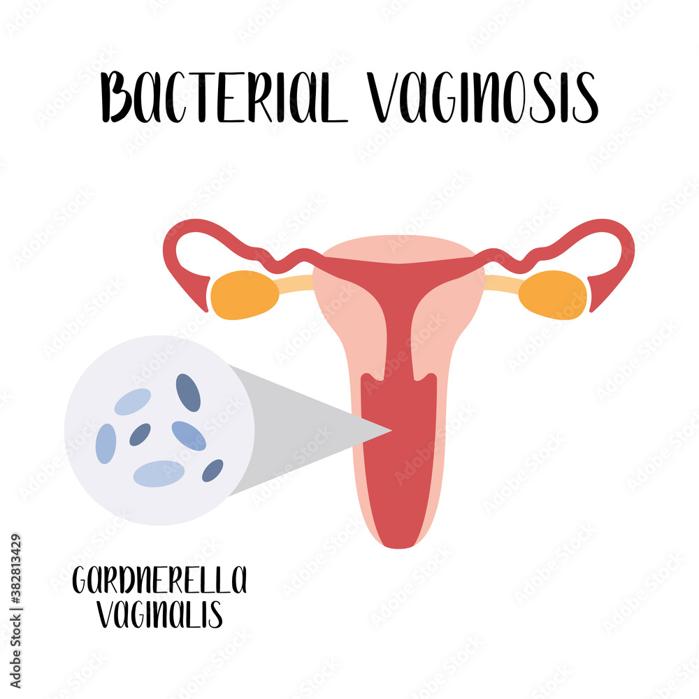 Vector de Stock Bacterial vaginosis. Gardnerella vagіnalis. Bacterial vaginal disease. Female ...