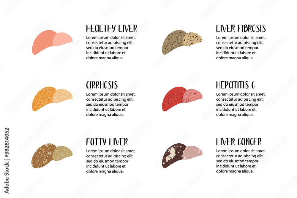Healthy liver and various liver diseases. Hepatology. Stages of liver ...