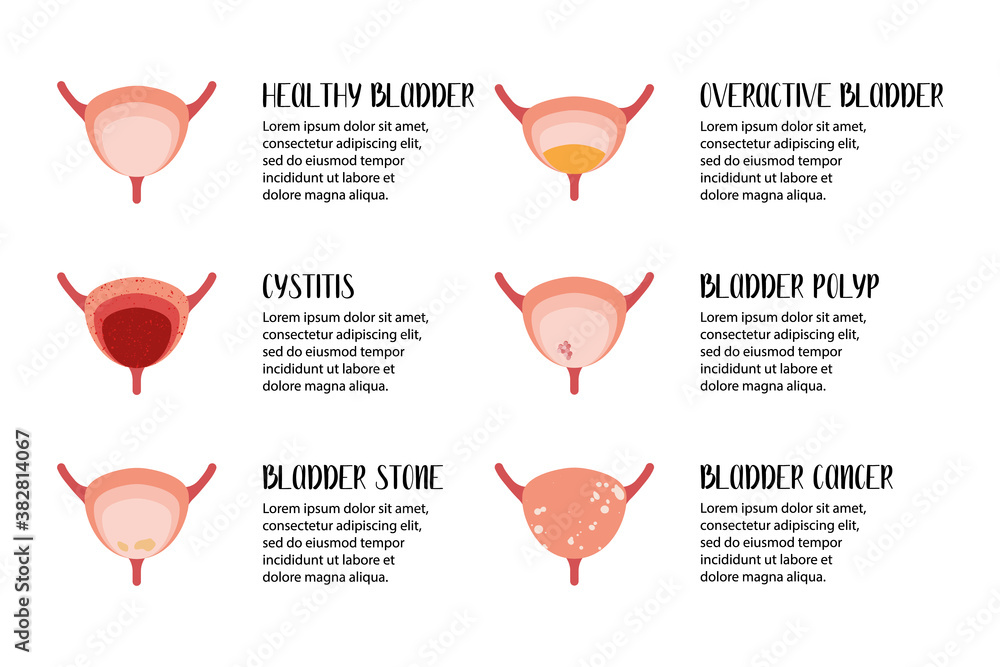 Bladder diseases. Cystitis, overactive bladder, stones, cancer, polyp ...