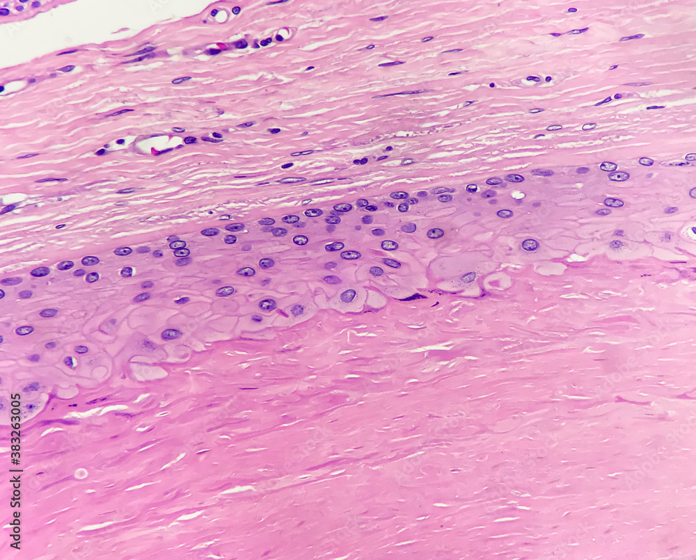 Trichilemmal cyst reveals squamous epithelial lining without granular ...